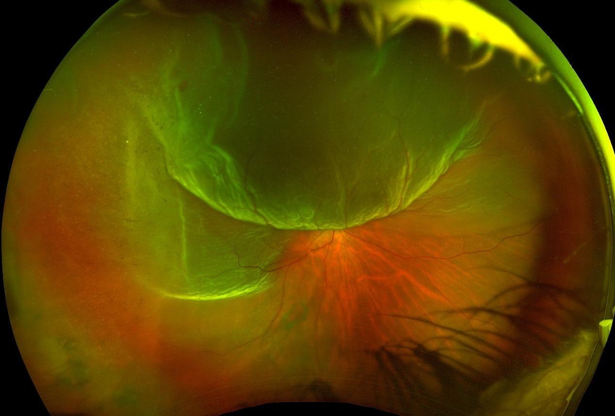 Le décollement de rétine - Pour la vision | Association CRO