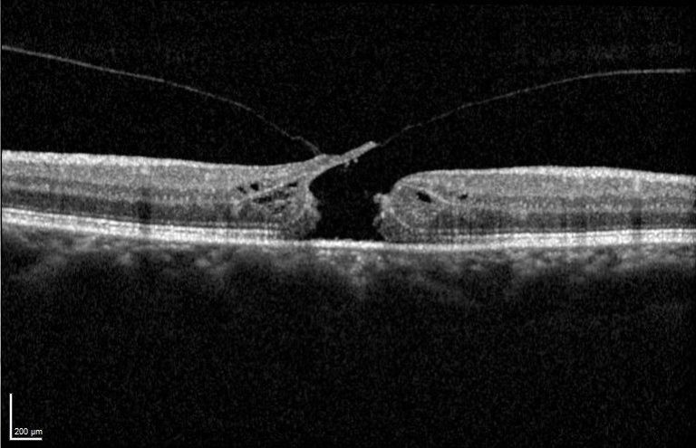 Le trou maculaire - Pour la vision | Association CRO