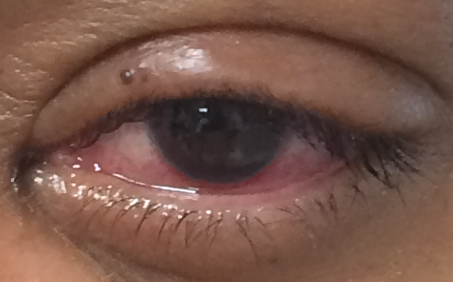 La conjonctivite - Pour la vision | Association CRO